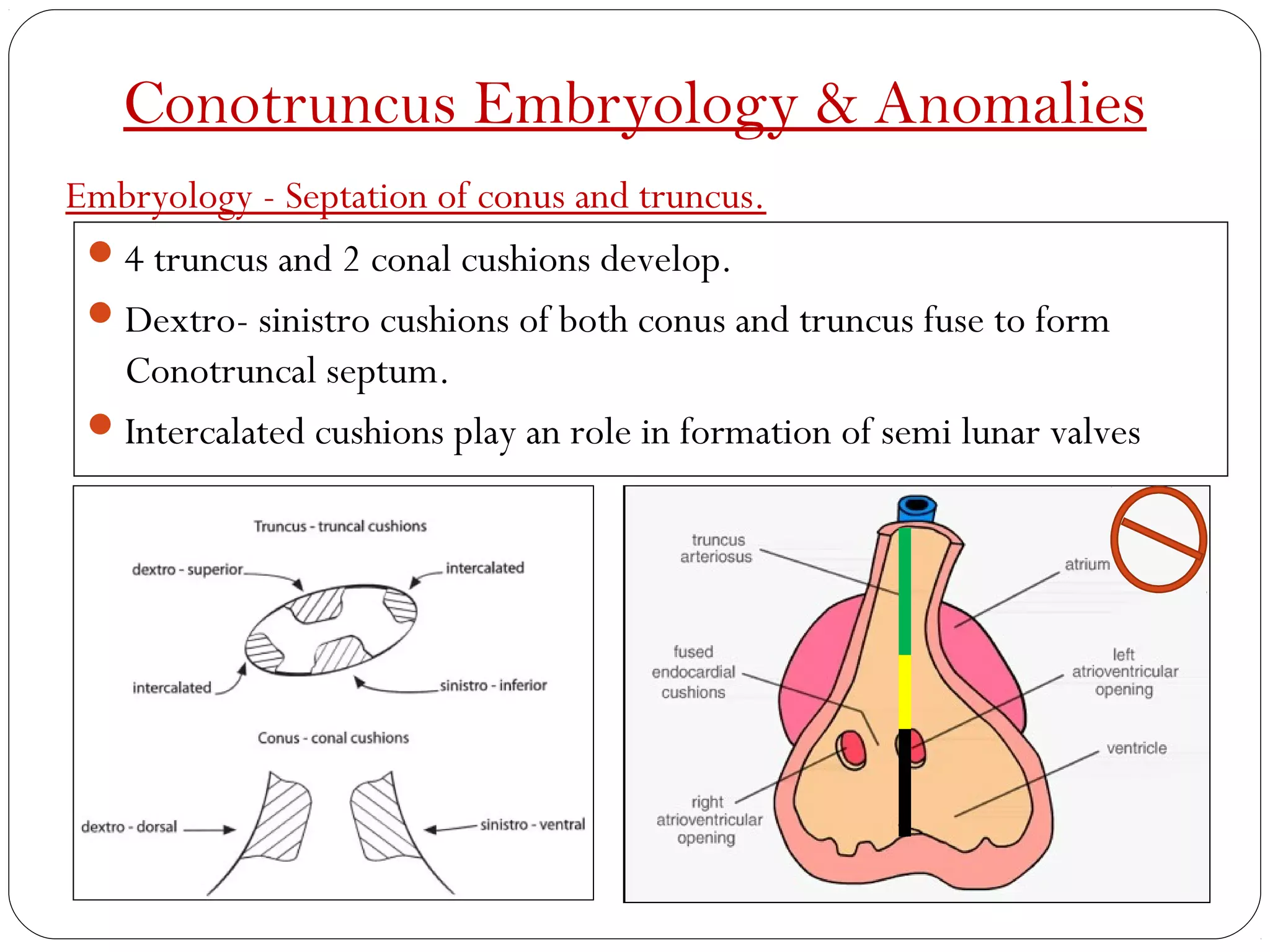 Conotruncal anamolies | PPT