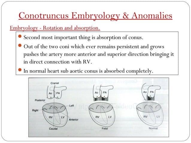 Conotruncal anamolies | PPT