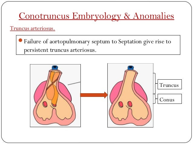 Conotruncal anamolies