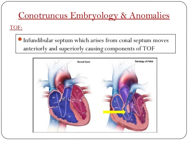 Conotruncal anamolies