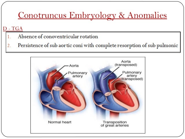 Conotruncal anamolies