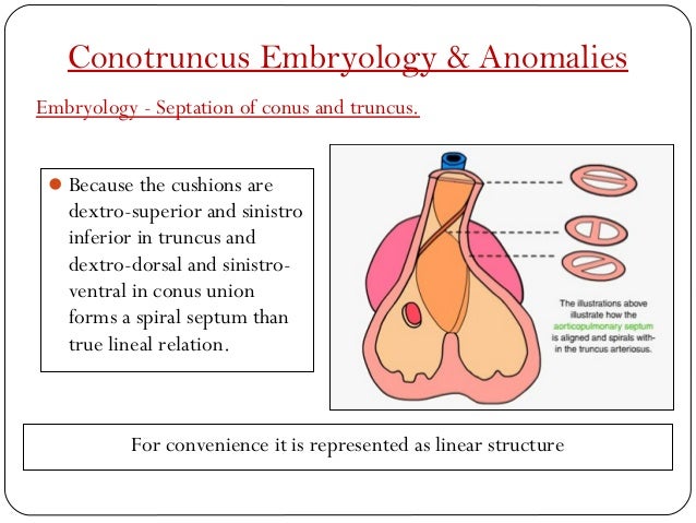 Conotruncal anamolies