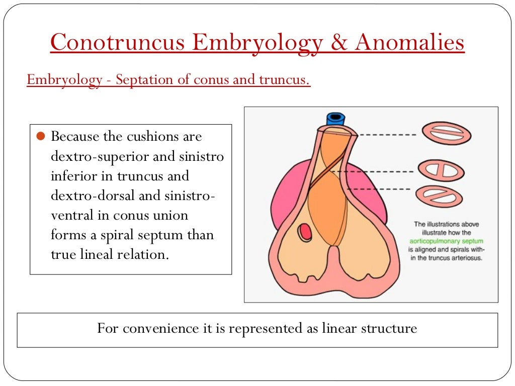 Conotruncal anamolies