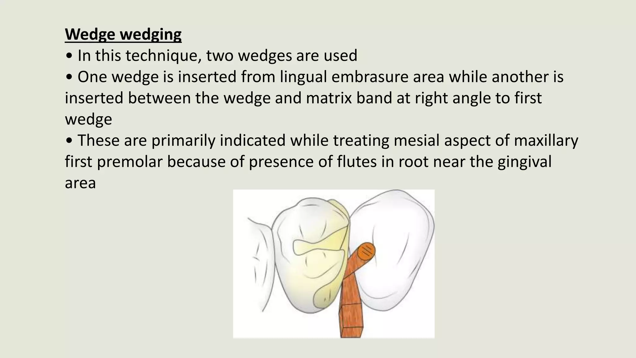 Wedging technique | PPTX