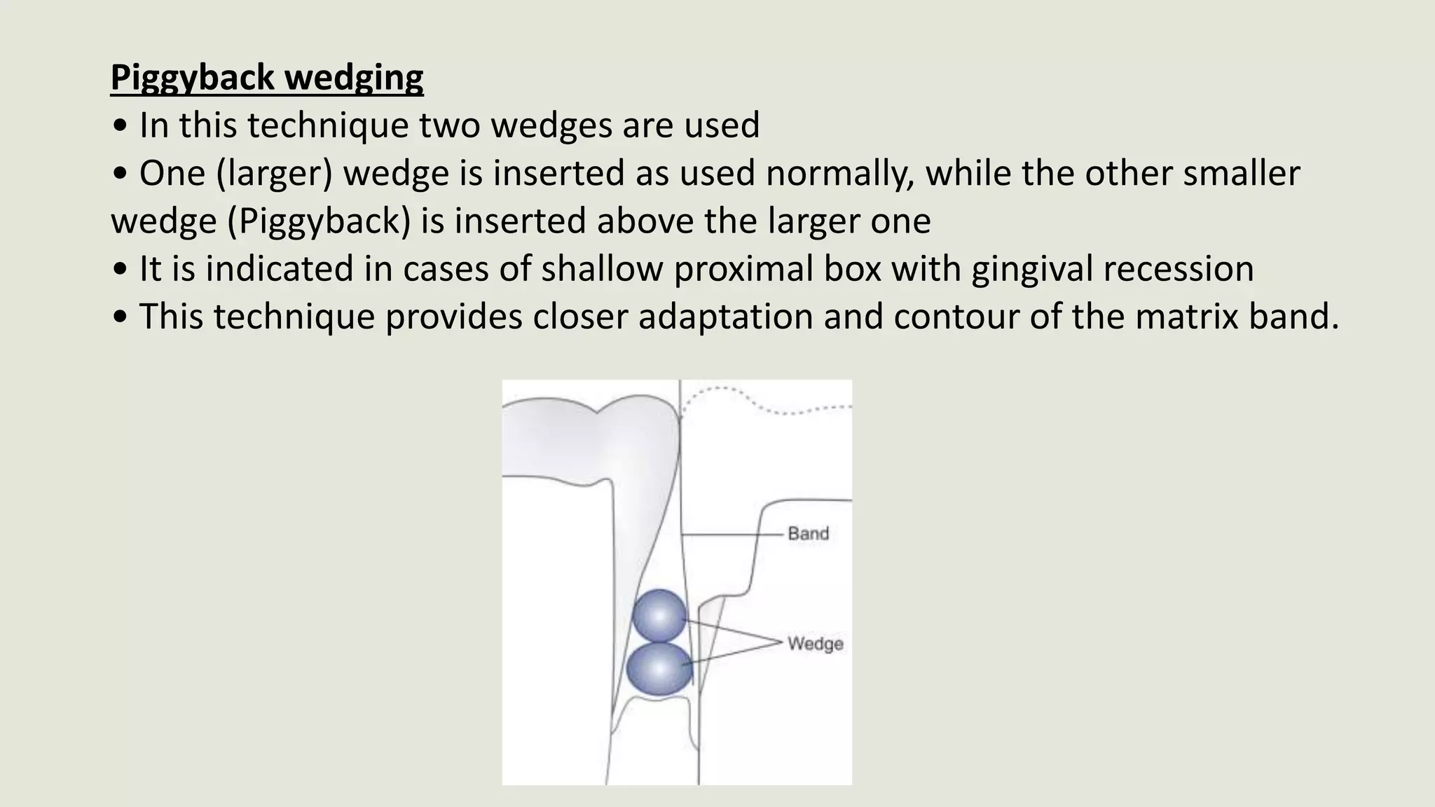 Wedging technique | PPTX