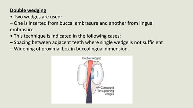 Wedging technique | PPTX