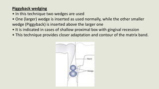 Wedging technique | PPTX