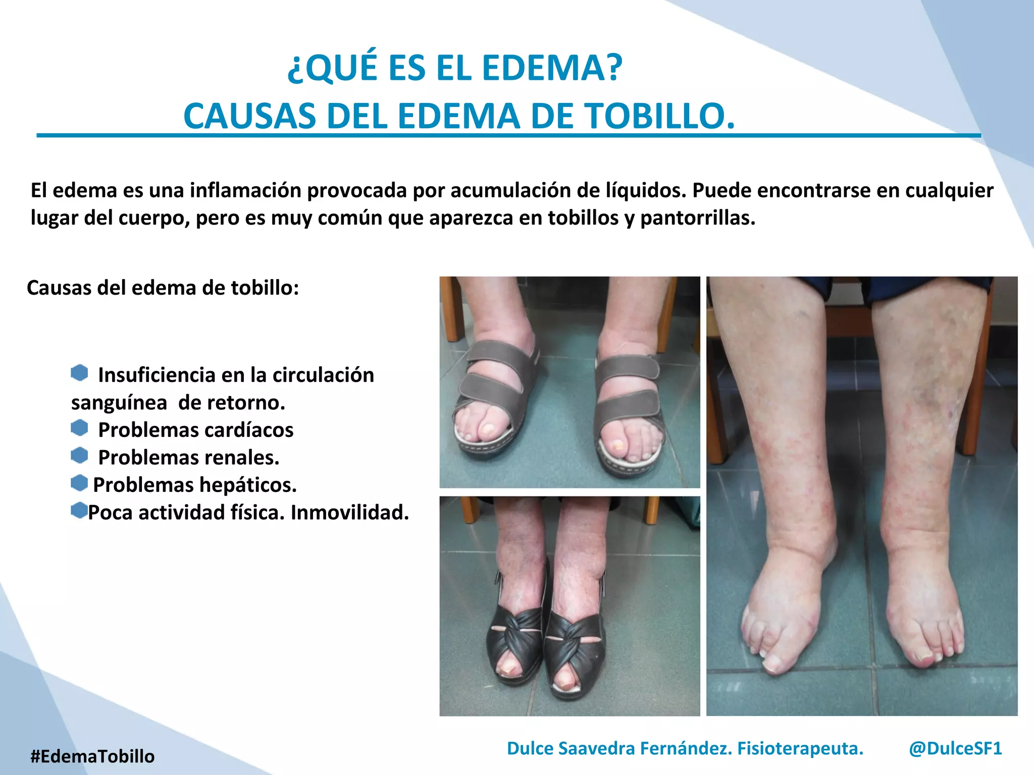 Consejos del fisio para el edema de tobillo. | PPT