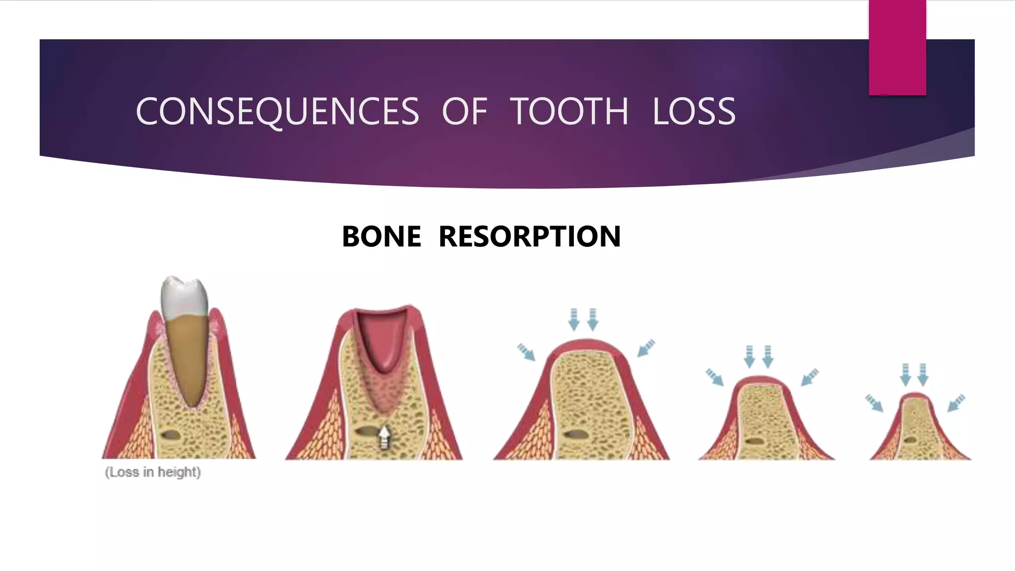 CONSEQUENCES OF TOOTH LOSS.pptx