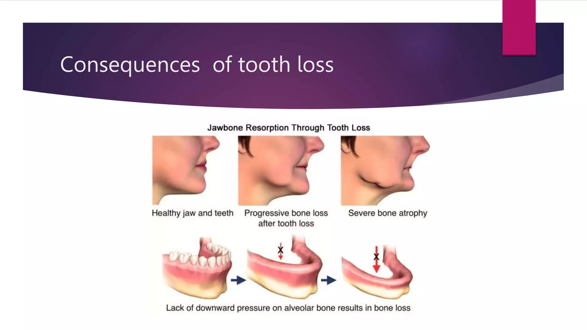 CONSEQUENCES OF TOOTH LOSS.pptx
