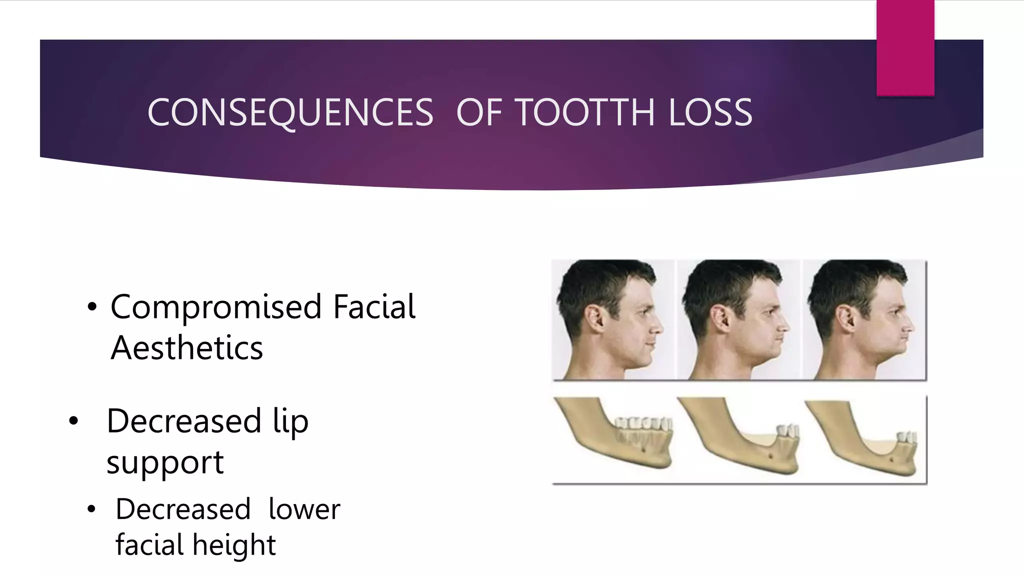 CONSEQUENCES OF TOOTH LOSS.pptx