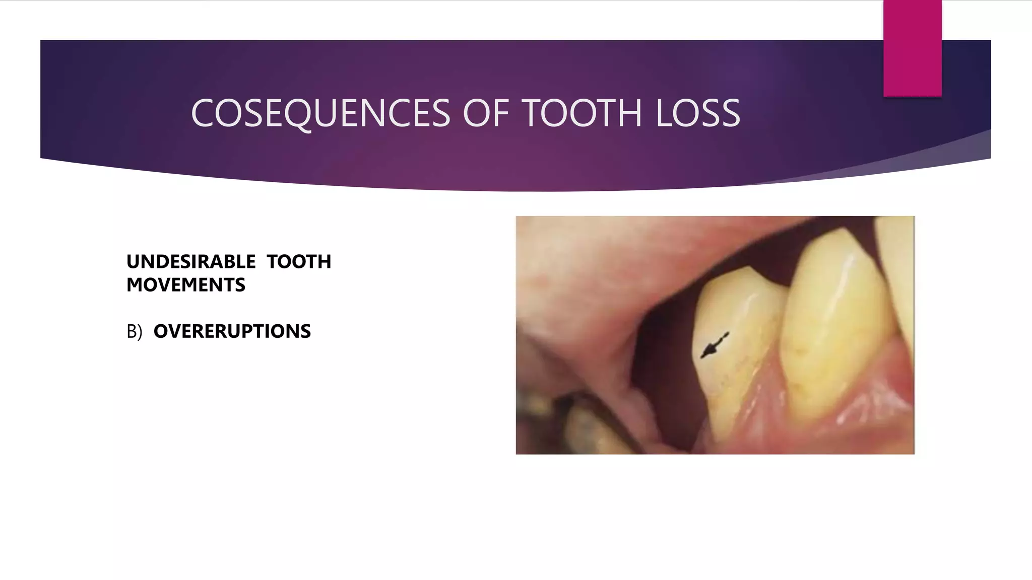 CONSEQUENCES OF TOOTH LOSS.pptx