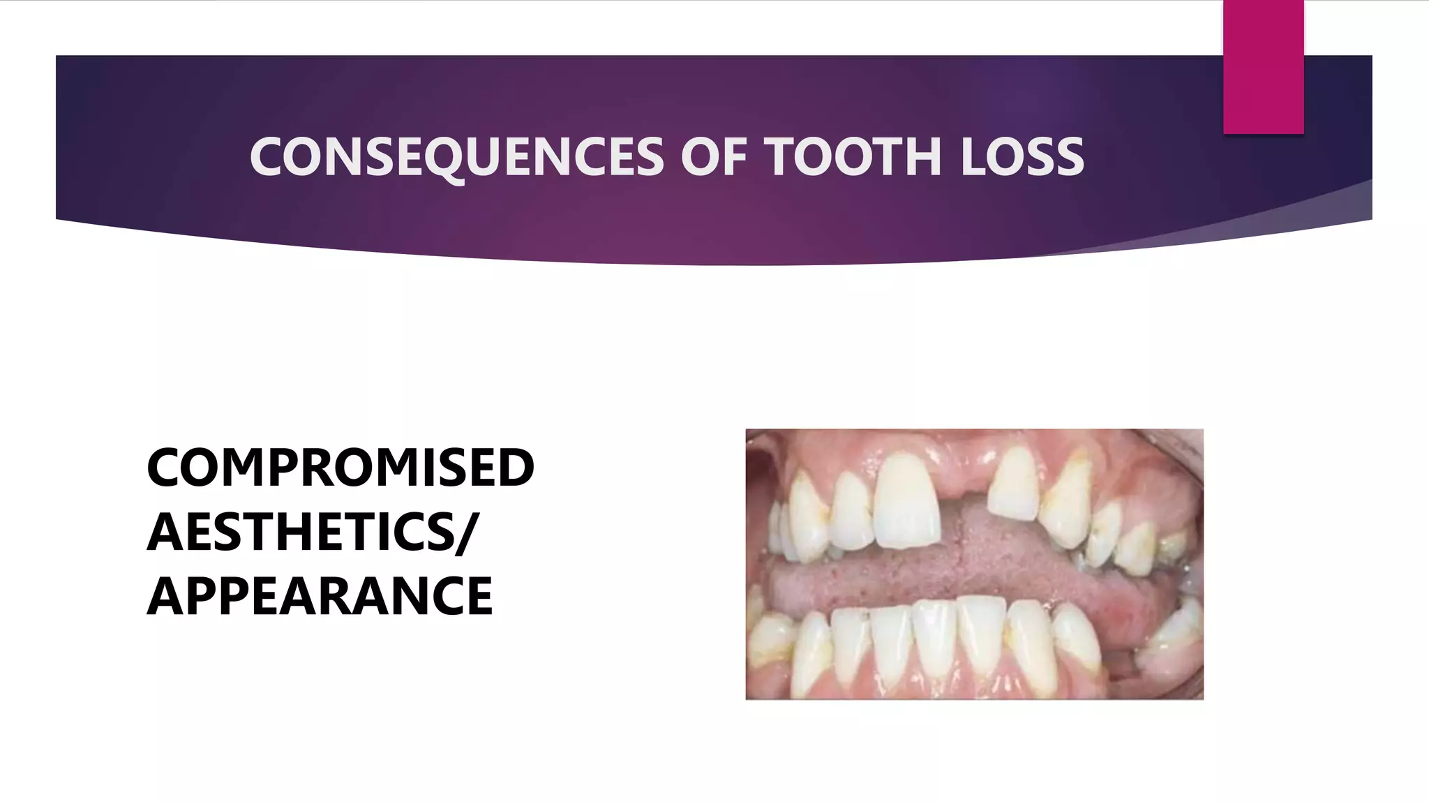 CONSEQUENCES OF TOOTH LOSS.pptx