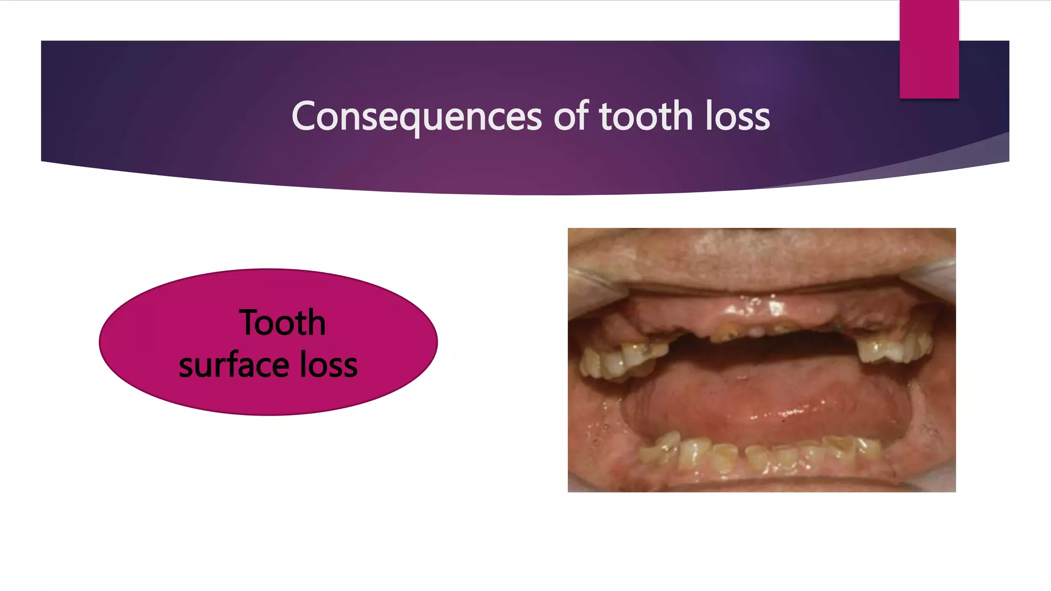 CONSEQUENCES OF TOOTH LOSS.pptx