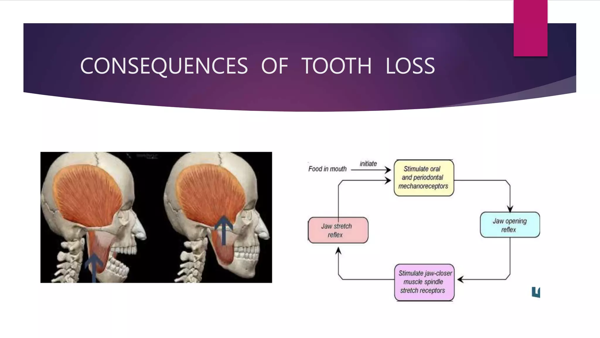 CONSEQUENCES OF TOOTH LOSS.pptx