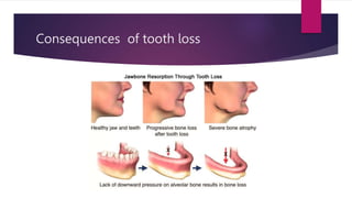 CONSEQUENCES OF TOOTH LOSS.pptx