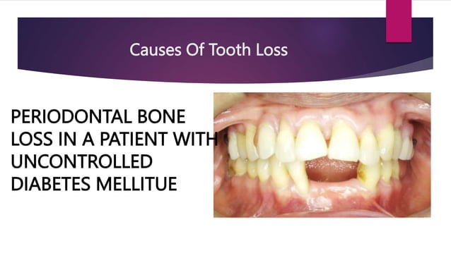 CONSEQUENCES OF TOOTH LOSS.pptx