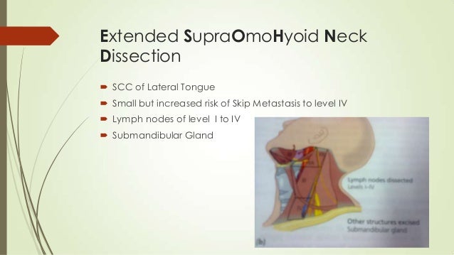 Supraomohyoid Neck Dissection Treatment – PWPK