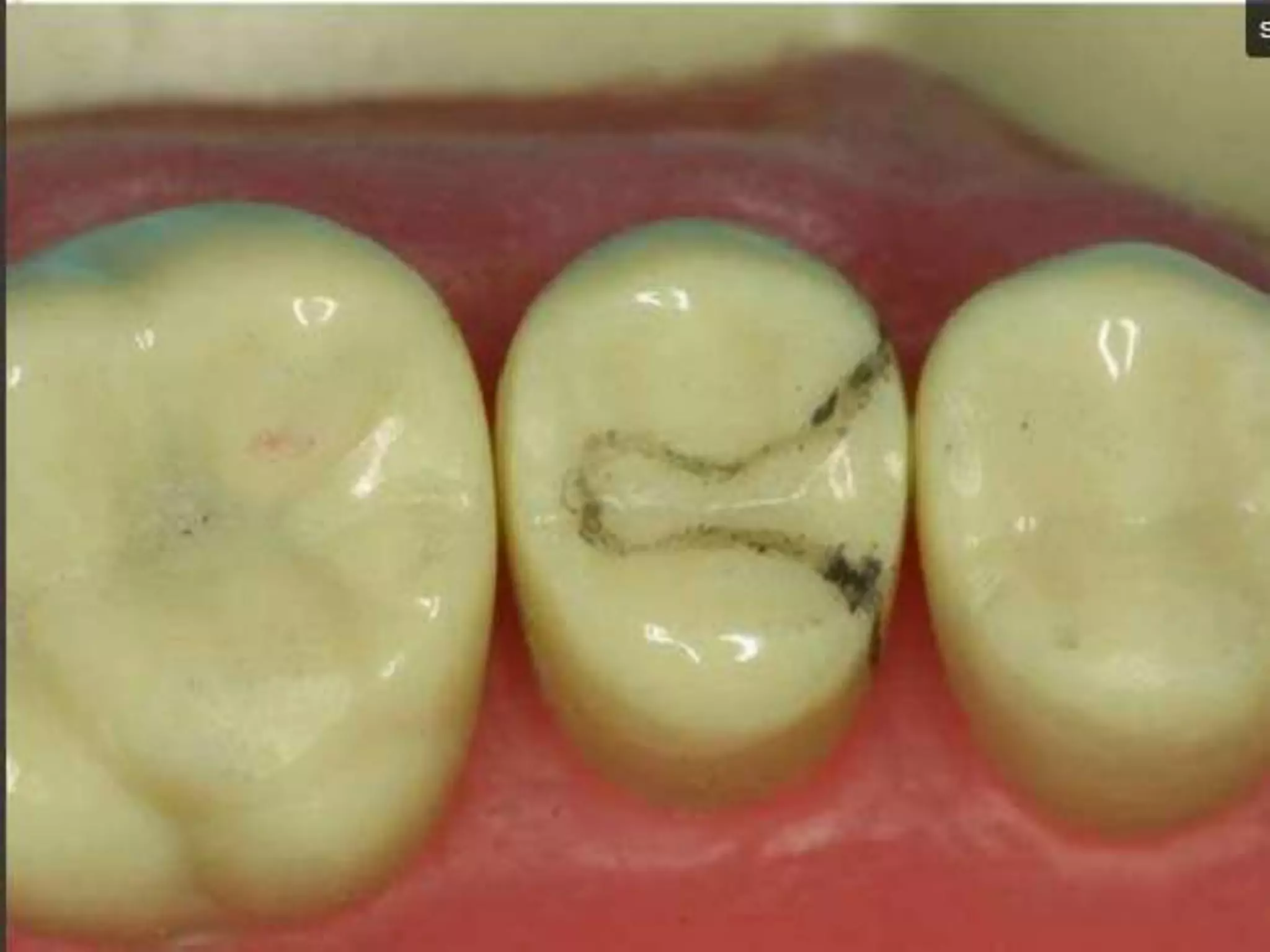 inlays&onlays | PPTX