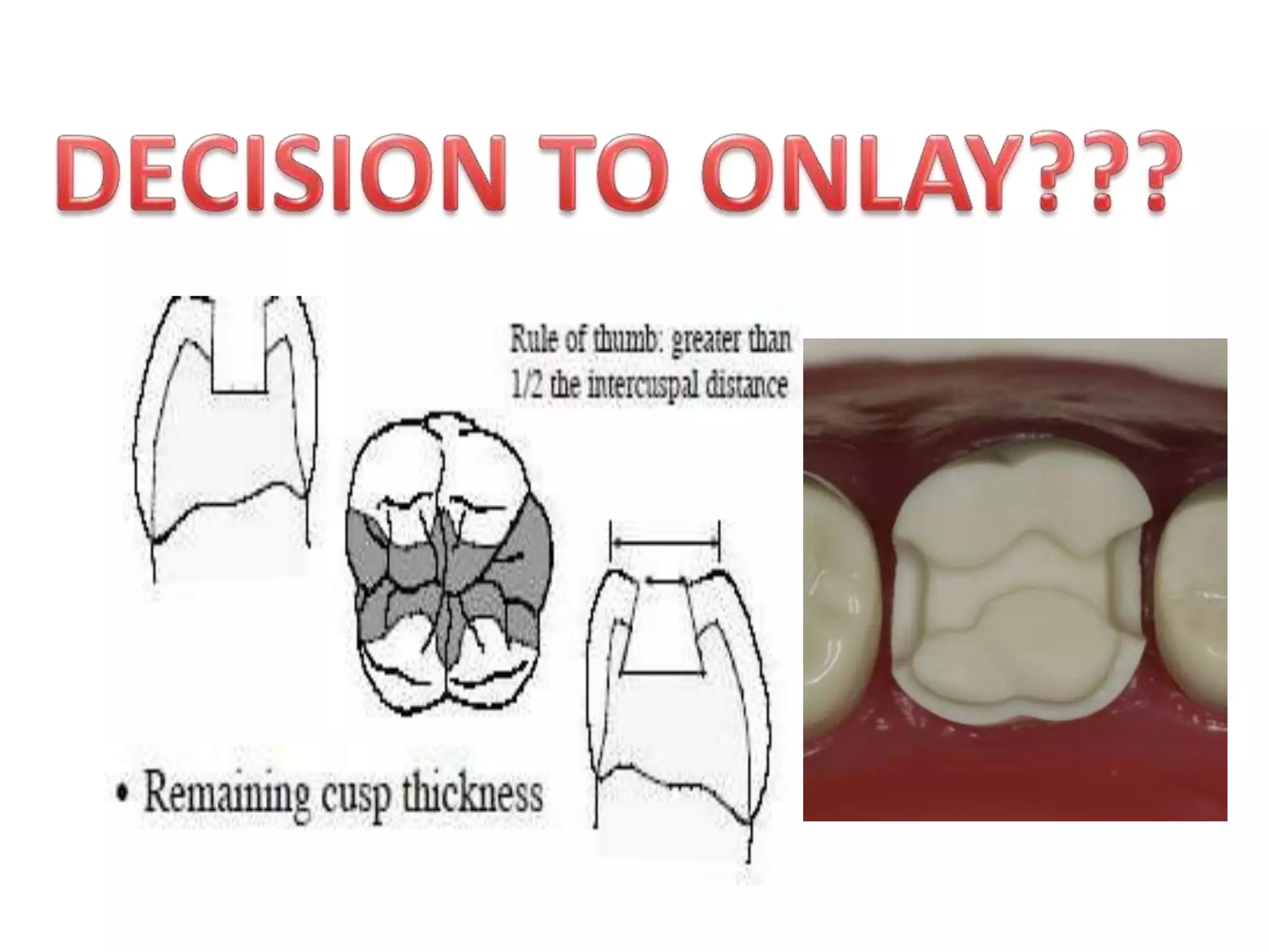 inlays&onlays | PPTX