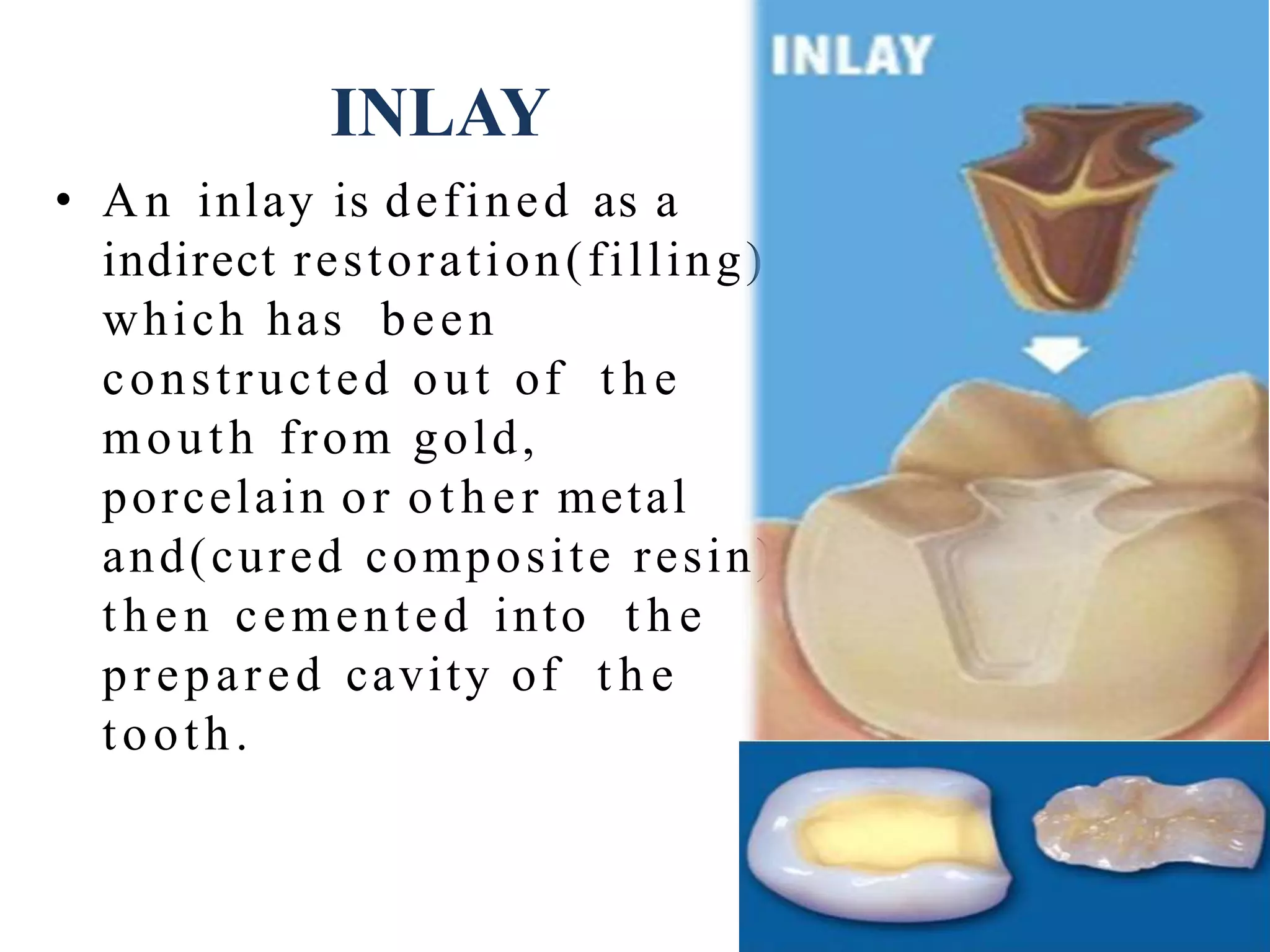 inlays&onlays | PPTX