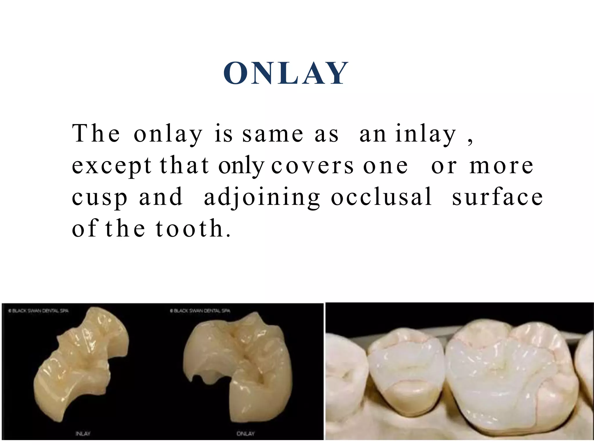 inlays&onlays | PPTX