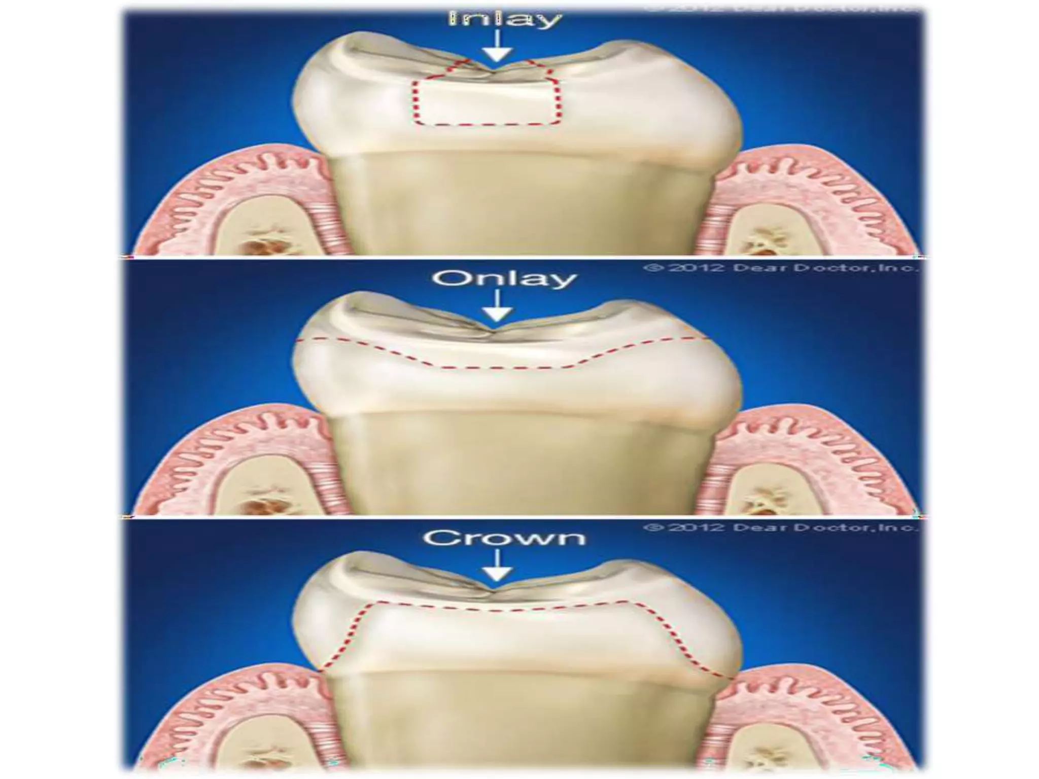 inlays&onlays | PPTX