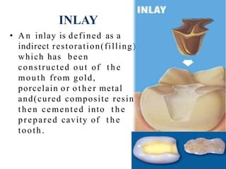 inlays&onlays | PPTX