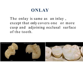 inlays&onlays | PPTX