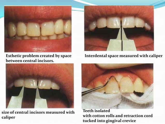 Conservative esthetic procedures | PPSX | Dental Health | Diseases and ...