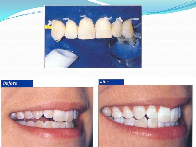 Conservative esthetic procedures | PPSX | Dental Health | Diseases and ...