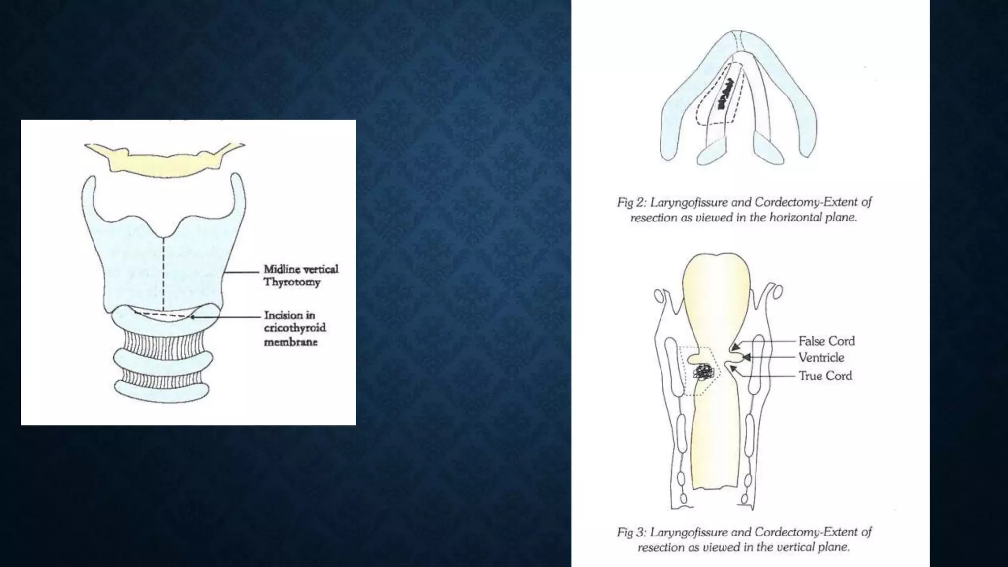 Conservative laryngeal surgery | PPTX