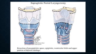 Conservative laryngeal surgery | PPTX