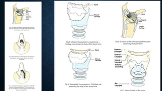 Conservative laryngeal surgery | PPTX