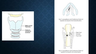 Conservative laryngeal surgery | PPTX