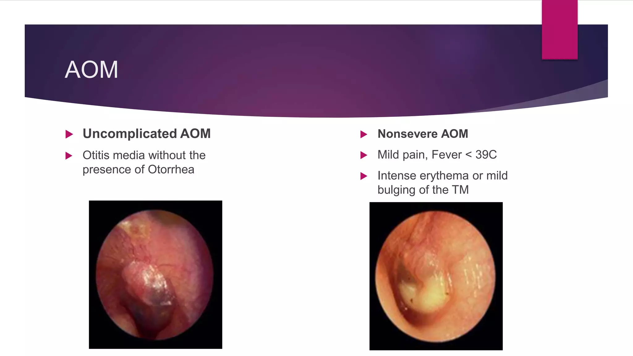 Conservative management of otitis media | PPTX