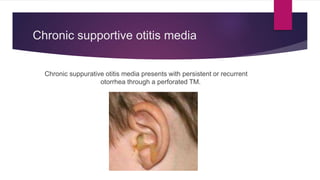 Conservative management of otitis media | PPTX