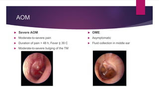 Conservative management of otitis media | PPTX