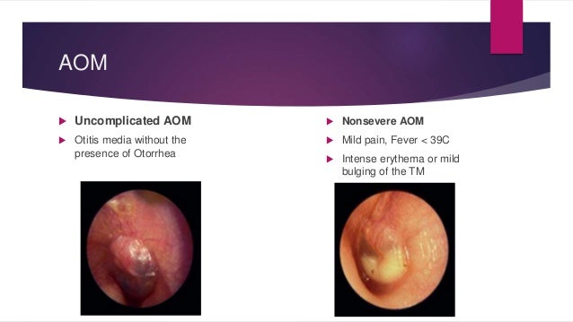 Conservative management of otitis media