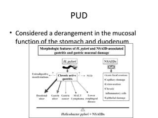 Conservative management of perforated peptic ulcers | PPT