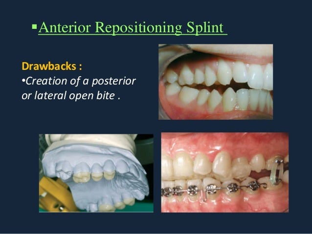 Conservative management of temporomandibular disorders