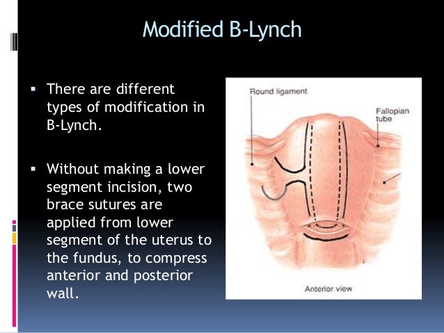 Conservative Mx of PPH