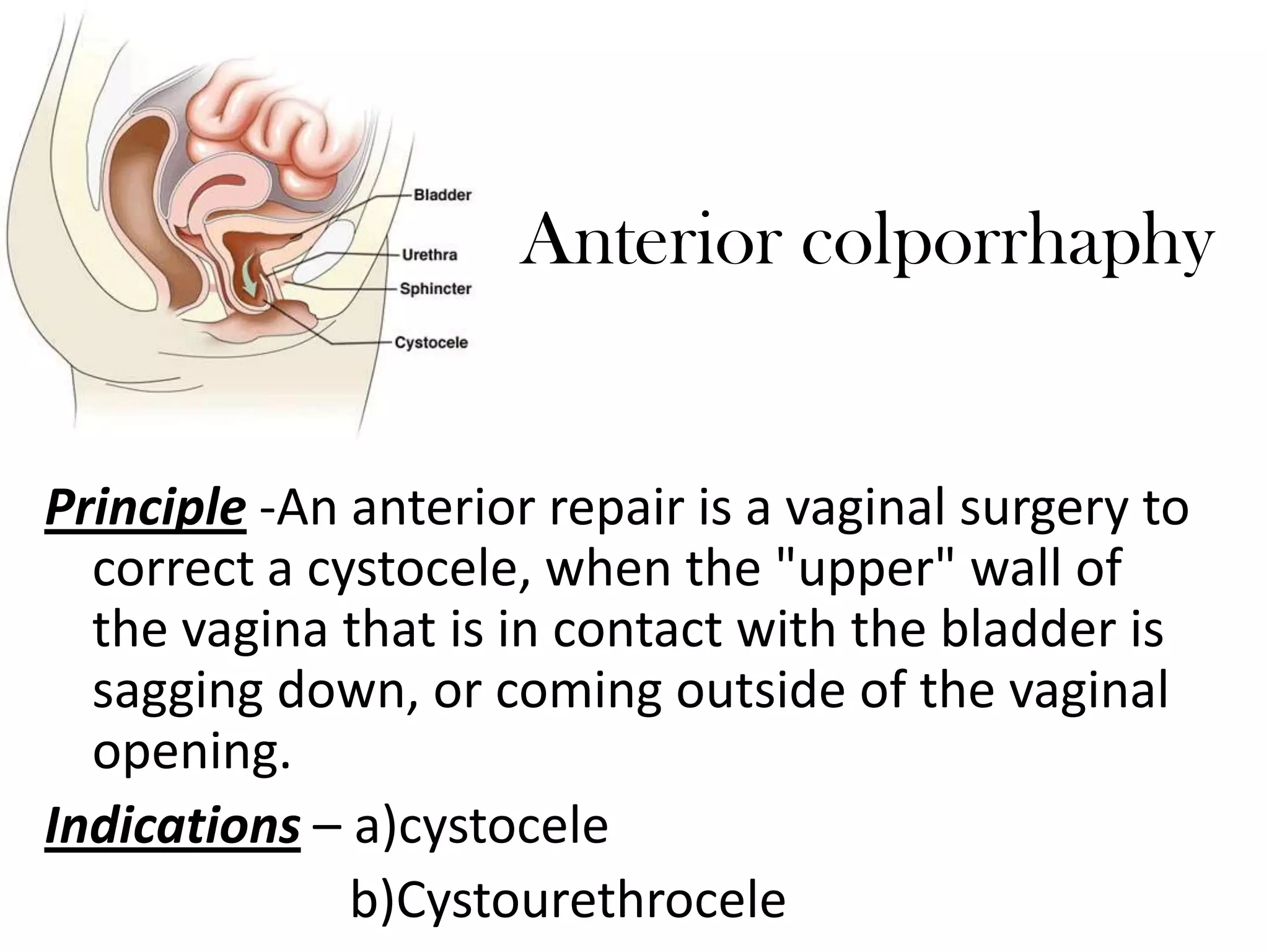 Conservative surgeries for genital prolapse | PPTX
