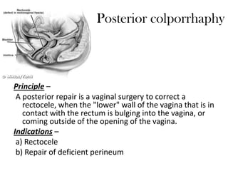 Conservative surgeries for genital prolapse | PPTX | Pregnancy ...