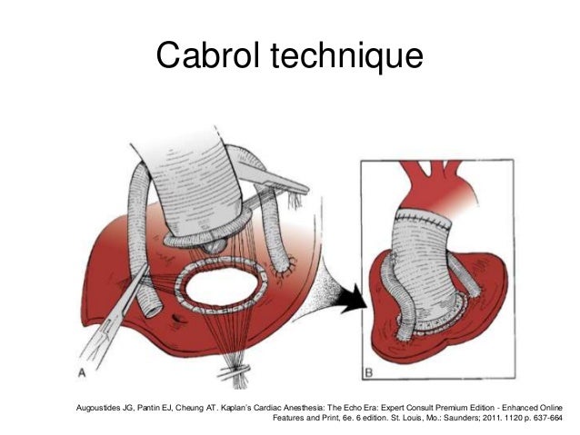 Anesthetic considerations in aortic surgery