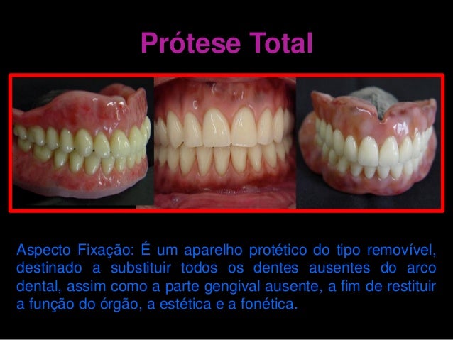 Considerações gerais sobre Prótese Total