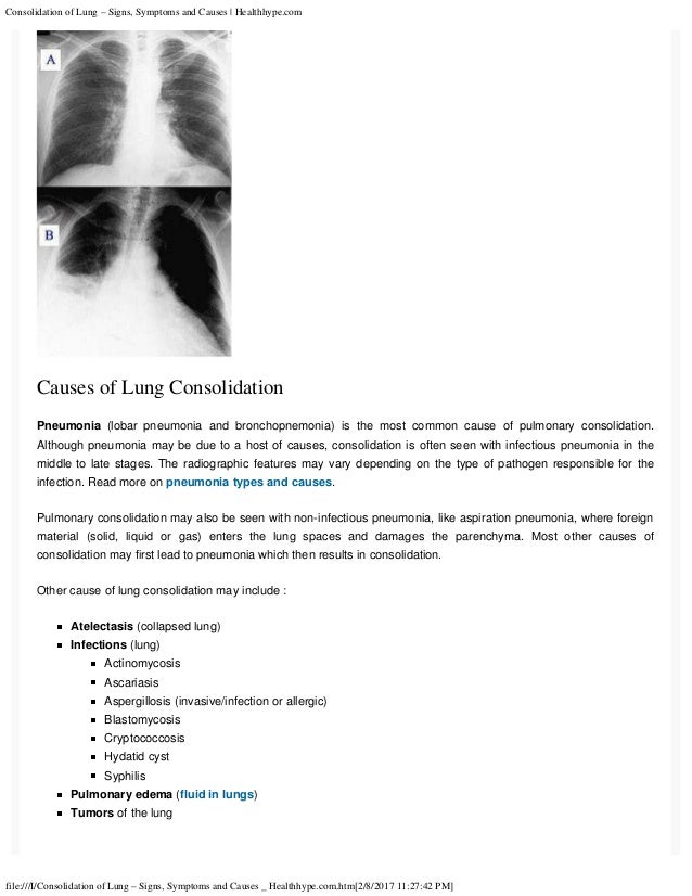 pulmonary consolidation treatment: white consolidation vs pleural ...