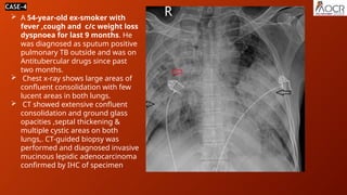 CONSOLIDATION poster in radiologyy .pptx
