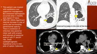 CONSOLIDATION poster in radiologyy .pptx