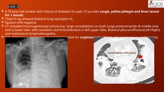 CONSOLIDATION poster in radiologyy .pptx